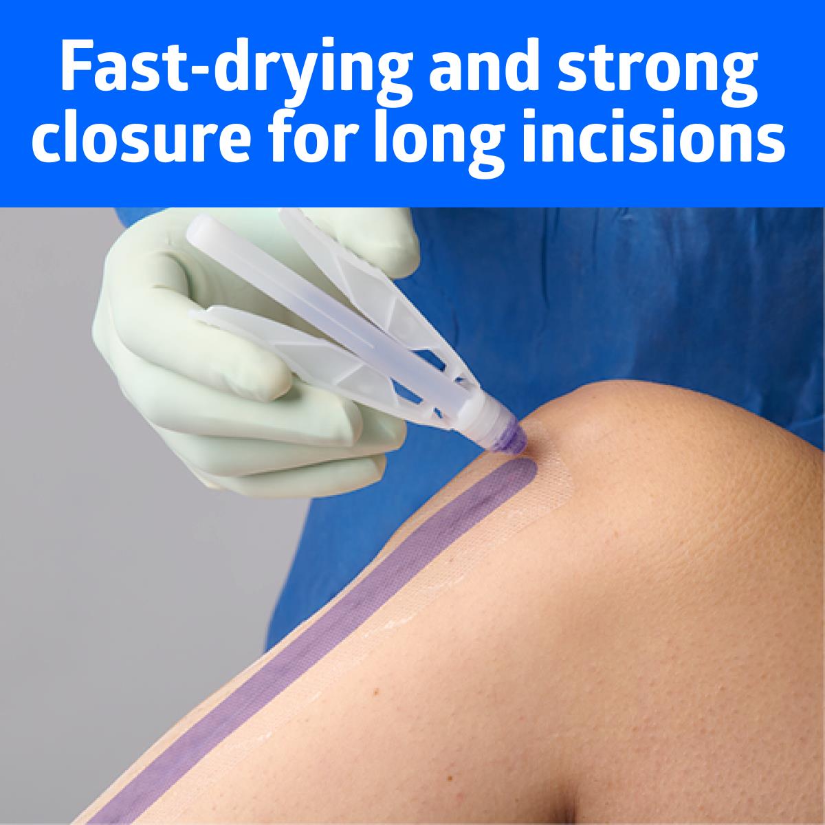 OptiClose Secure Wound Closure Device | Medline