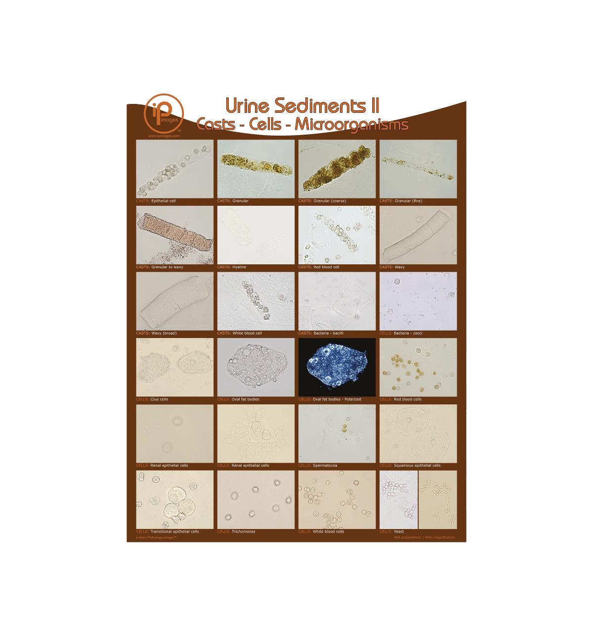 Urine Sediments Poster | Medline