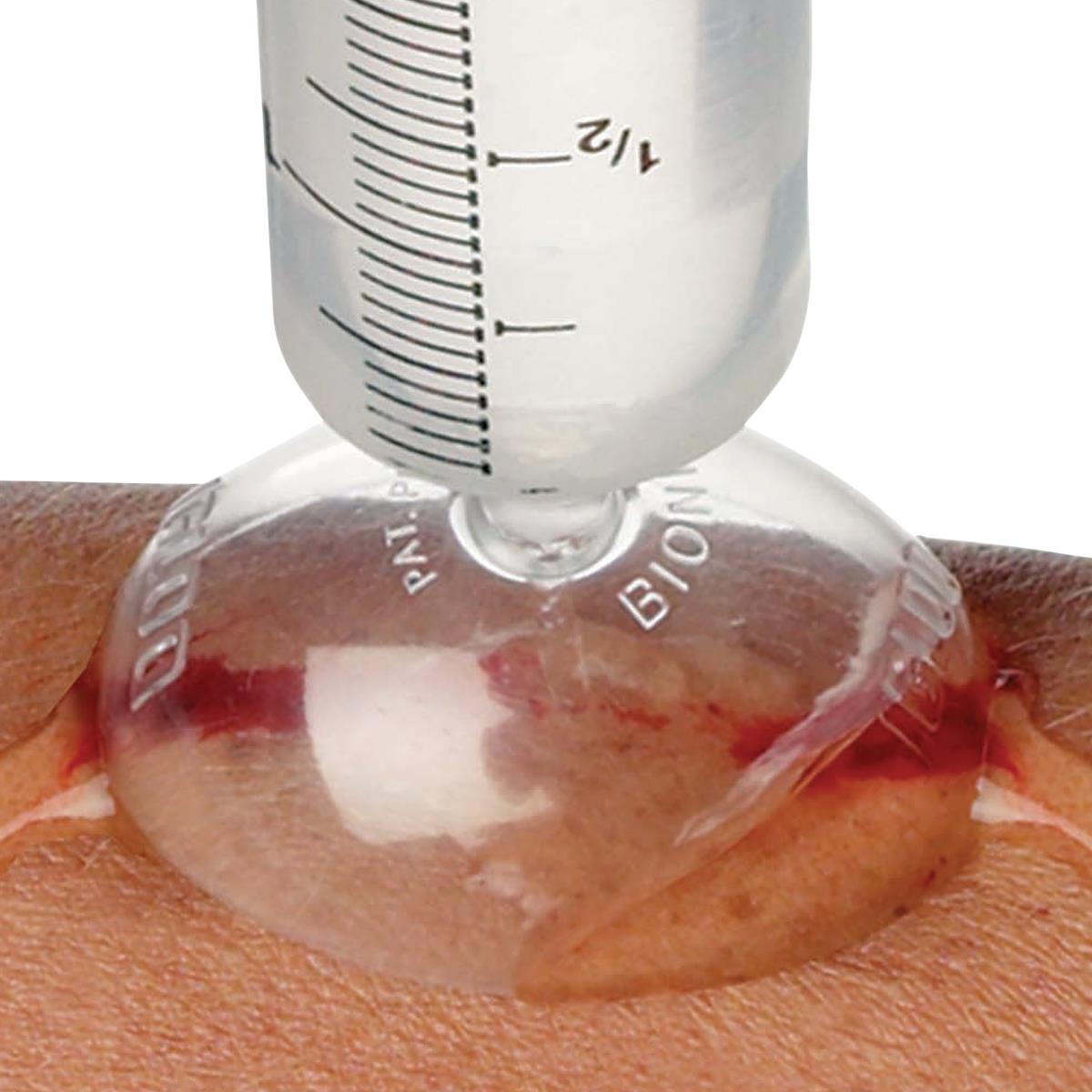 Igloo Wound Irrigation System | Medline