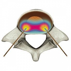 Kimberly-Clark TRANSDISCAL Cooled RF Probe Kit | Medline Industries, Inc.