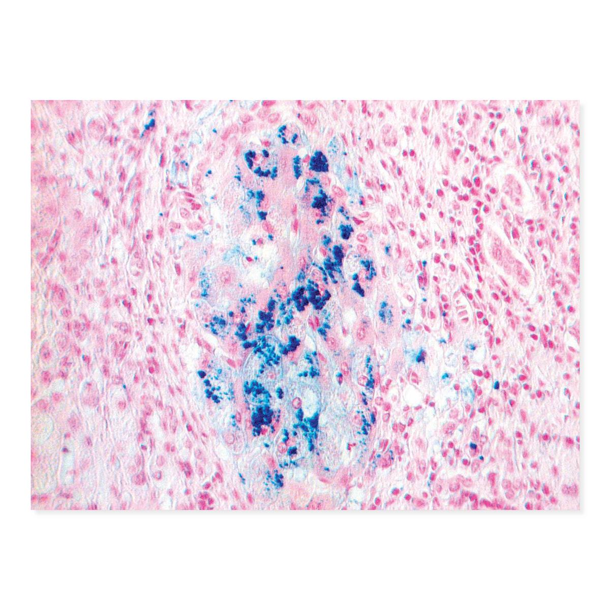 Iron Stain Kit | Medline