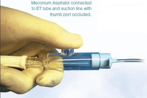 Meconium Aspirators | Medline