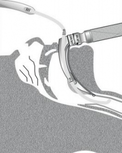 Introducers (Bougie) by SunMed | Medline Industries, Inc.