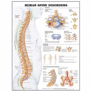 Human Spine Disorders Anatomical Chart by Wolters Kluwer | Medline ...