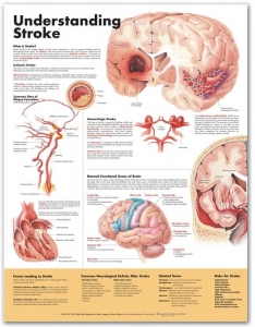 Understanding Stroke Anatomical Chart | Medline Industries, Inc.