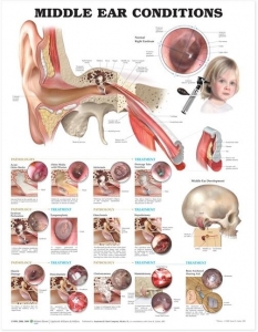 Middle Ear Conditions Anatomical Chart | Medline Industries, Inc.