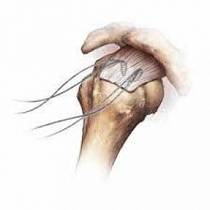 Rotator Cuff Repair Titanium Suture Anch | Medline