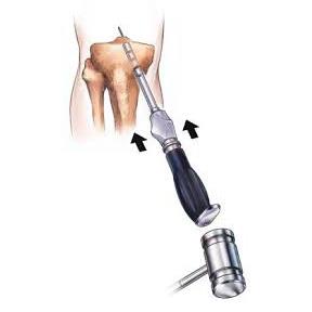 Bone Dowel Harvesting Tube | Medline