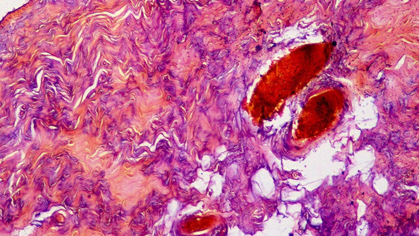 Chronic wounds: Collagen might be the answer - Medline