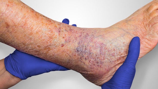 6 things to know when treating venous leg ulcers