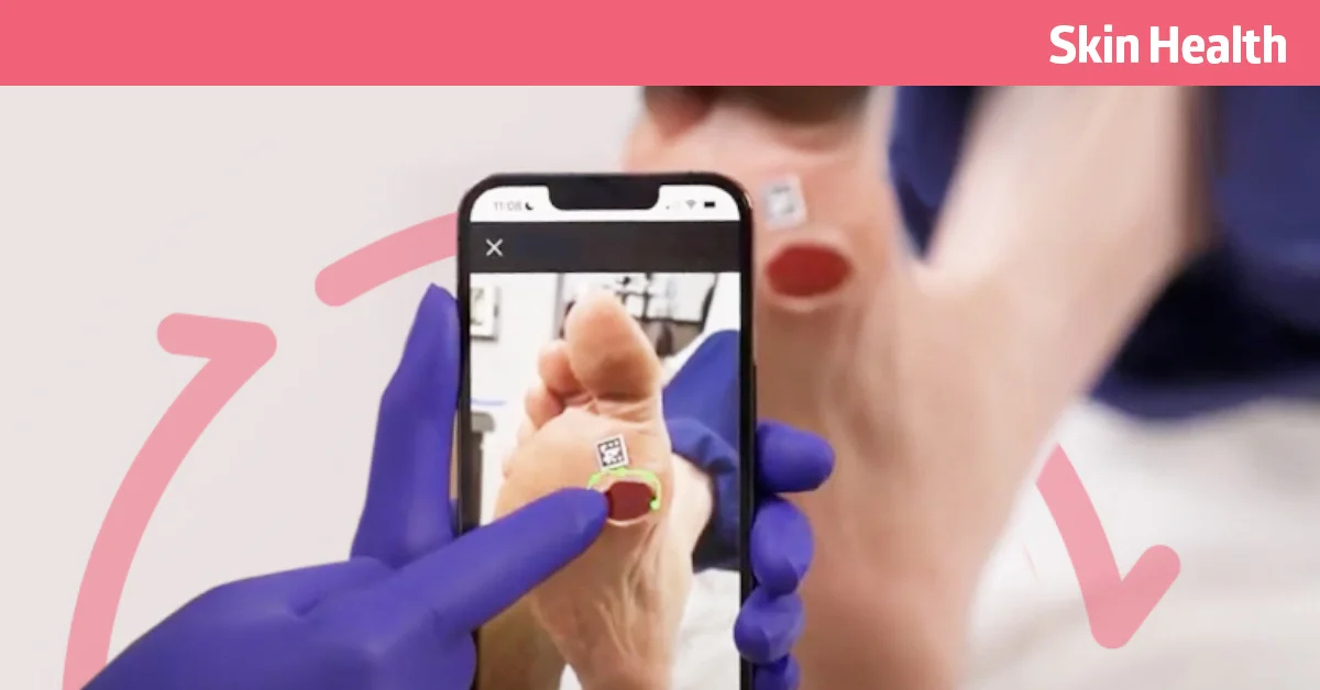 Skin Health: Digital Wound Photography - Medline