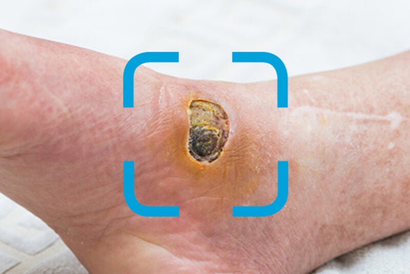 Arterial vs venous ulcers: What's the difference?