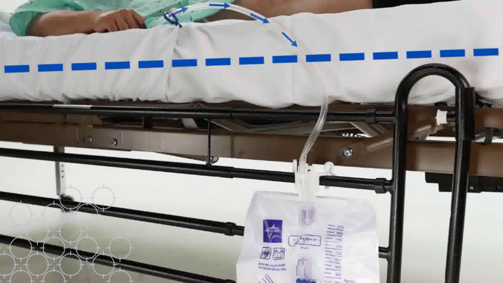 Avoid a Foley dependent loop and more: 5 catheter care tips