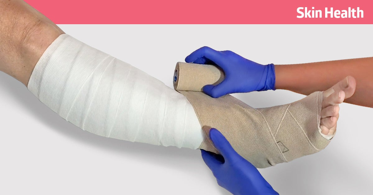 Venous stasis- Medline