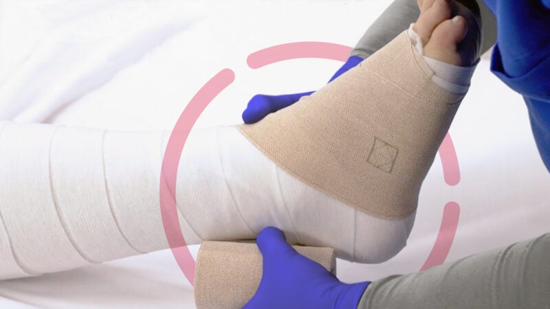 Is an Unna boot the right choice to treat venous leg ulcers?