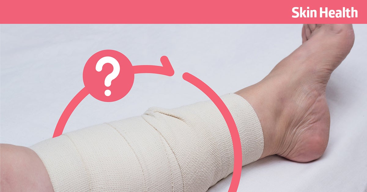 Venous stasis: What staff should know to help improve care