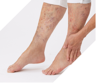 System Of Products: Venous Stasis - Medline