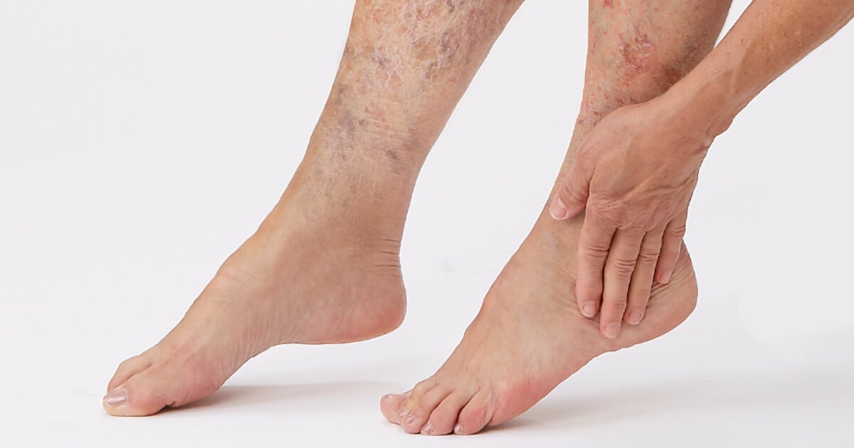 System Of Products: Venous Stasis - Medline