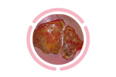 Break the non-healing cycle of chronic wounds - Medline