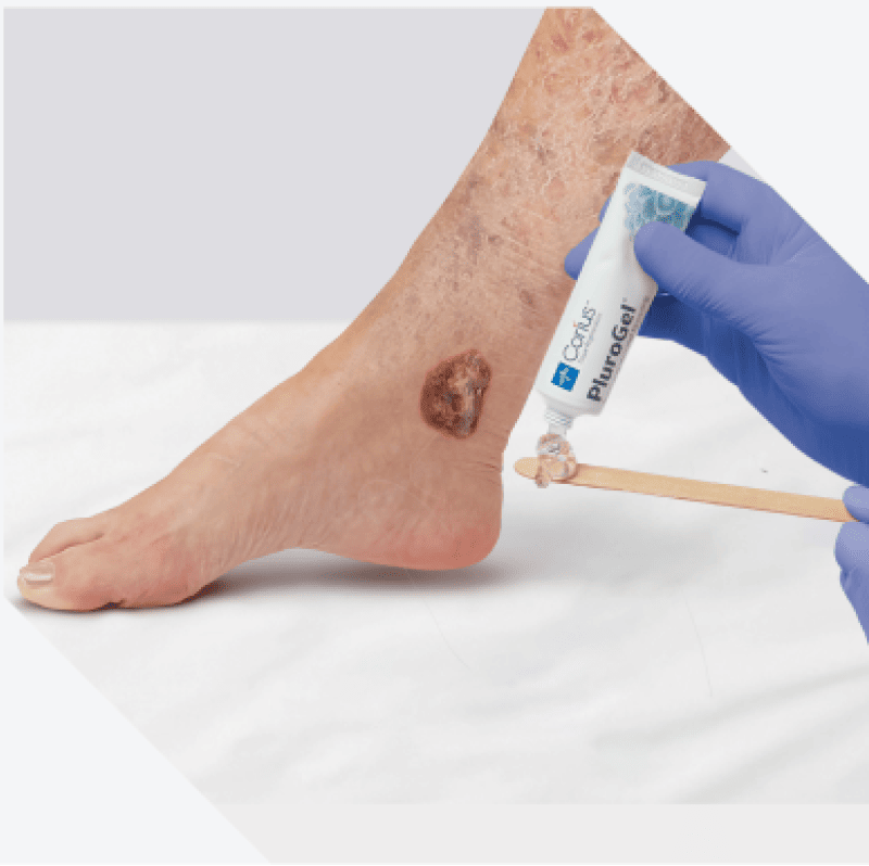 Chronic Wound Care Products