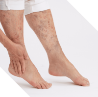 System Of Products: Venous Stasis - Medline