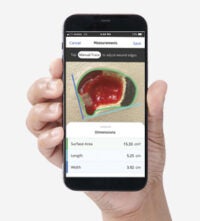 Wound measurement tools: Your guide to what works best