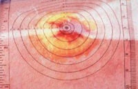 Wound measurement tools: Your guide to what works best