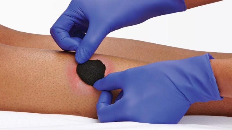 What is IoPlex® and how can it help with non-healing wounds?