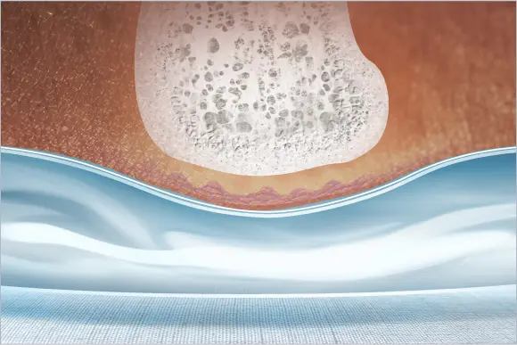 OptiView® Transparent Dressing with HydroCore™ Technology