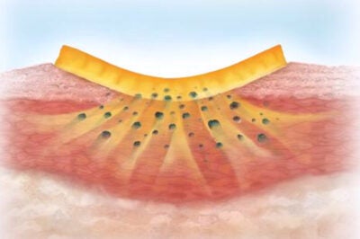 Debridement: What clinicians need to know