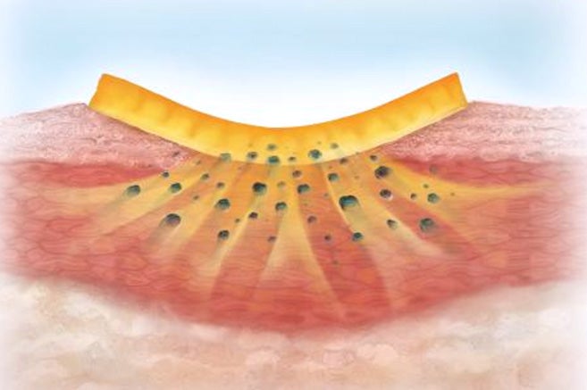 Debridement: What clinicians need to know