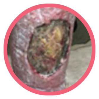 What is IoPlex® and how can it help with non-healing wounds?