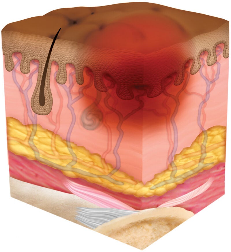 Pressure injury stages: What they are and why they matter