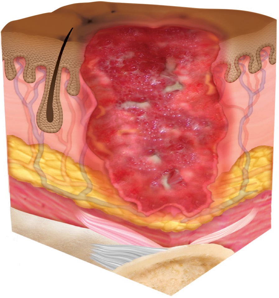 Pressure injury stages: What they are and why they matter