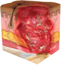 Pressure injury stages: What they are and why they matter