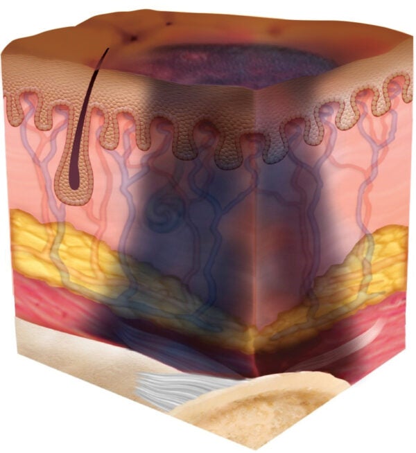 Pressure injury stages: What they are and why they matter