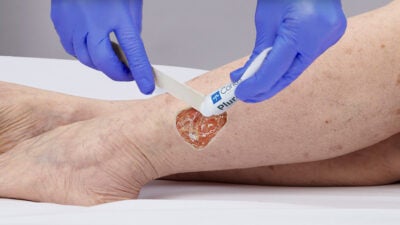 Debridement: What clinicians need to know