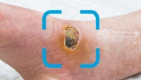 Arterial vs venous ulcers: What's the difference?