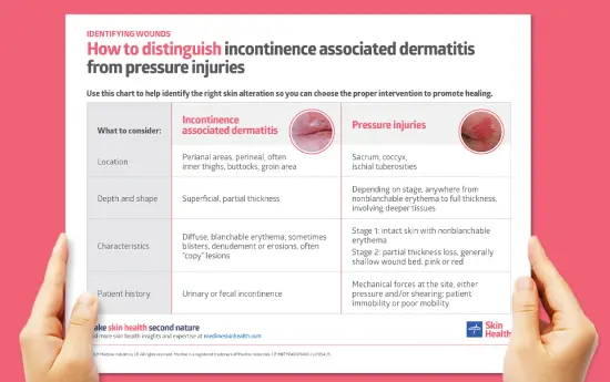 How to distinguish IAD from pressure injuries - Medline