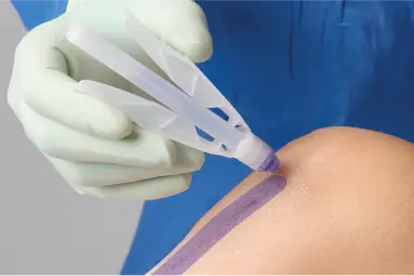 OptiClose topical skin adhesive products – Medline