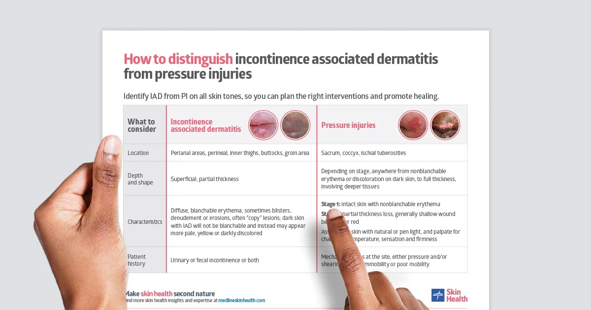 How to distinguish IAD from pressure injuries - Medline