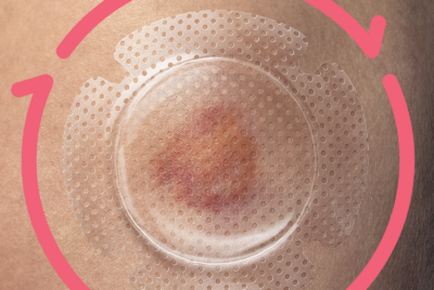 Deep tissue pressure injuries: How to identify and treat them